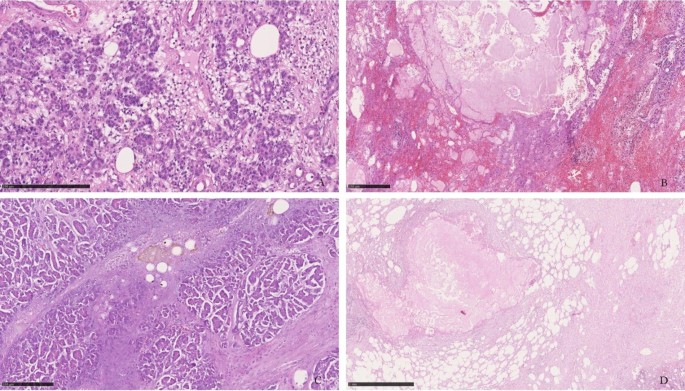 Acute Pancreatitis | SpringerLink