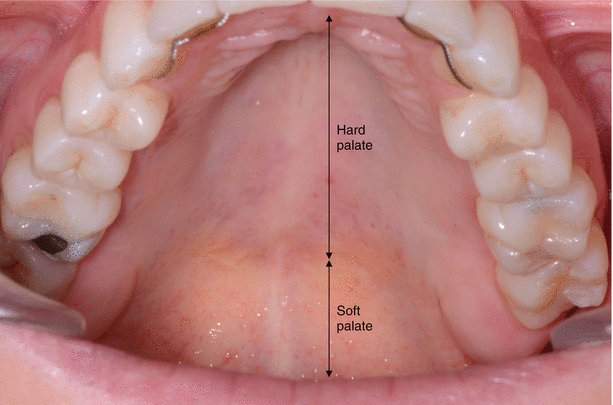 Hard And Soft Palate Diagram