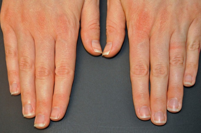 Nails in Systemic Disease | SpringerLink