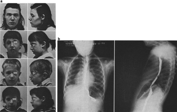 Aortic Arch Anomaly with Peculiar Facies and Mental Retardation ...