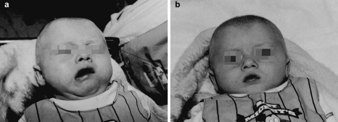 Cayler Cardiofacial Syndrome | SpringerLink