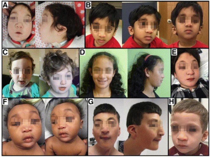 Congenital Heart Defects, Dysmorphic Facial Features, and Intellectual ...
