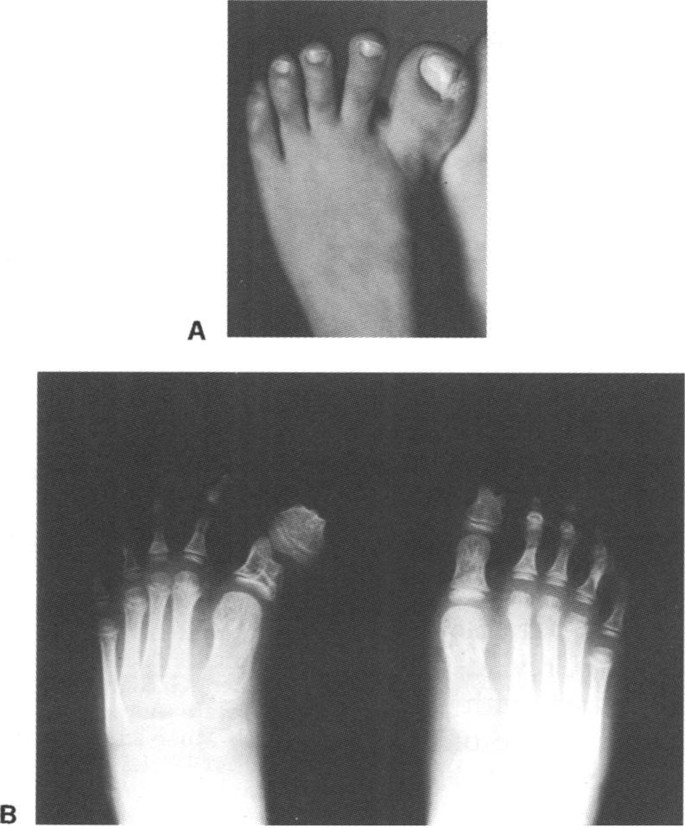 Congenital Heart Defects, Hamartomas of the Tongue, and Polysyndactyly ...