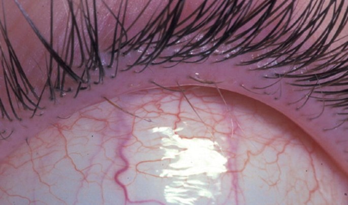 Distichiasis with Congenital Anomalies of the Heart and Peripheral ...