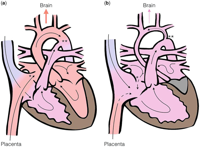 Hypoplastic Left Heart Syndrome (HLHS): Types 1 and 2 | Springer Nature ...