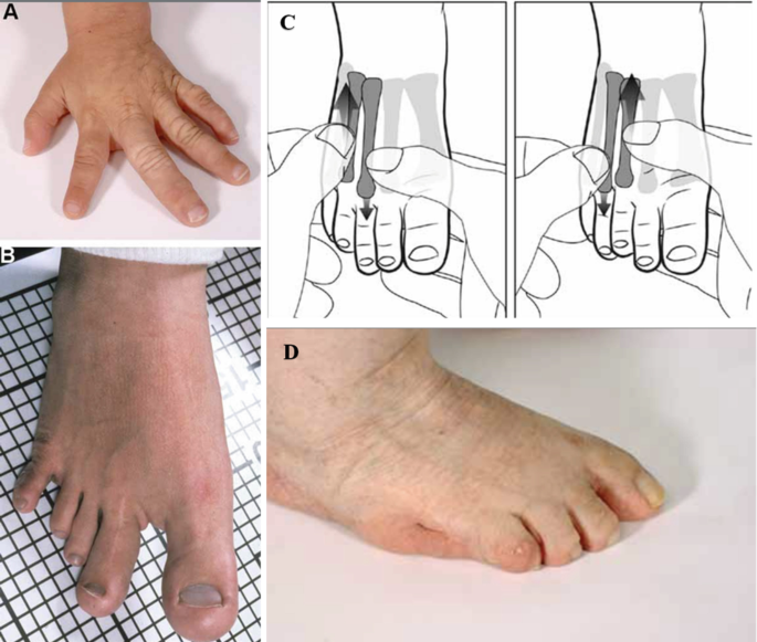 Klippel-Trenaunay-Weber Syndrome | SpringerLink