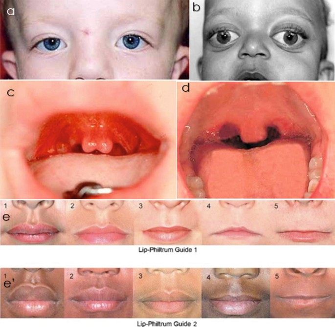 Loeys-Dietz Syndrome (LDS): Types 1–5 | SpringerLink