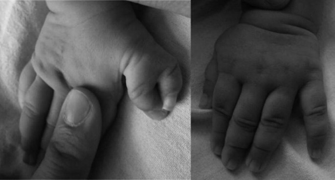 Lung Agenesis, Congenital Heart Defects, and Thumb Anomalies Syndrome ...