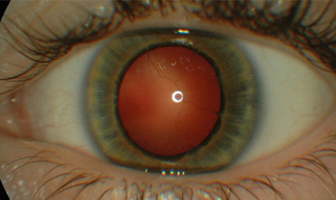 Multisystemic Smooth Muscle Dysfunction Syndrome | SpringerLink