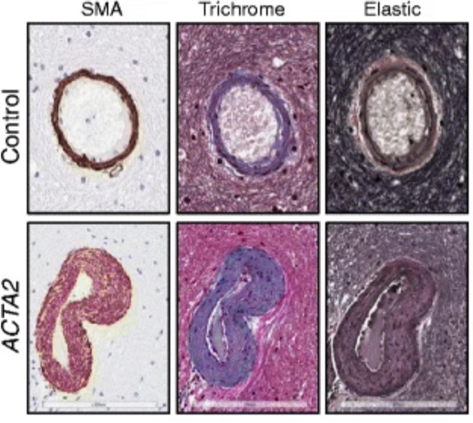 Multisystemic Smooth Muscle Dysfunction Syndrome | Springer Nature Link ...