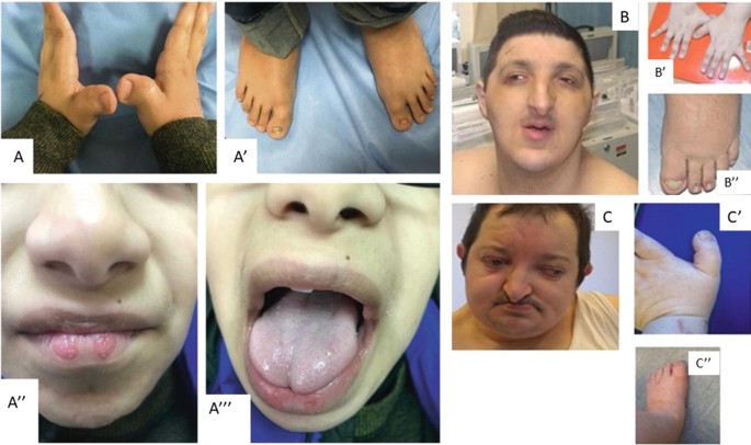 Proximal Chromosome 16p13.3 Deletion Syndrome | SpringerLink