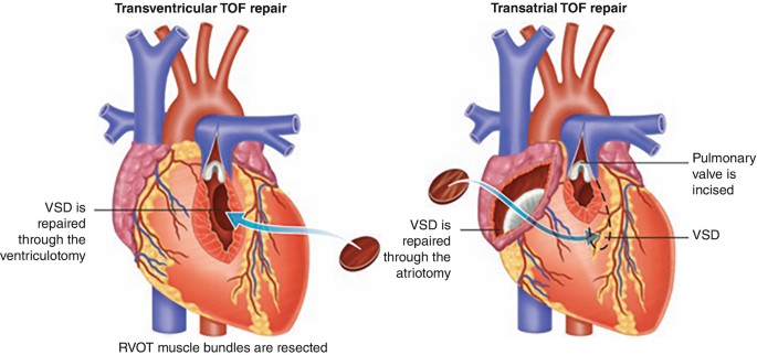 Tetralogy of Fallot Syndrome | SpringerLink