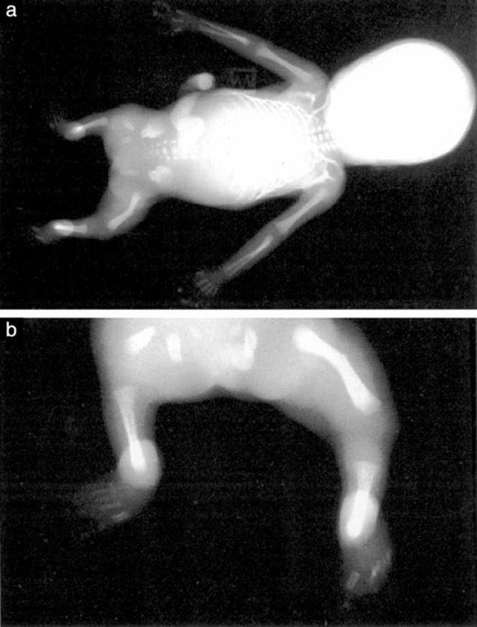 Femur Fibula Ulna Syndrome | Springer Nature Link (formerly SpringerLink)
