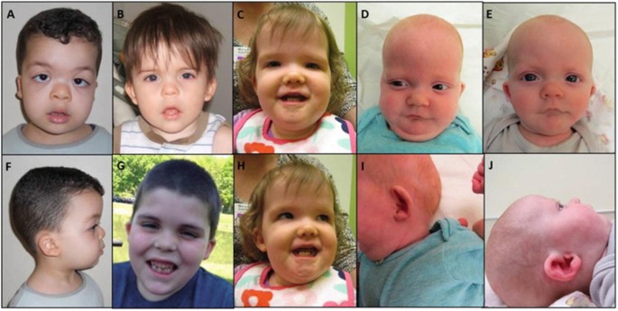 Chromosome 1q21.1 Duplication Syndrome | SpringerLink