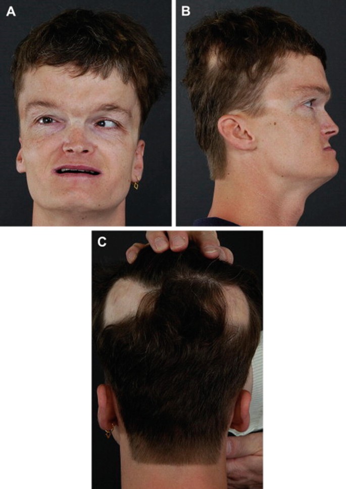 Gomez-Lopez-Hernandez Syndrome (GLHS) | SpringerLink