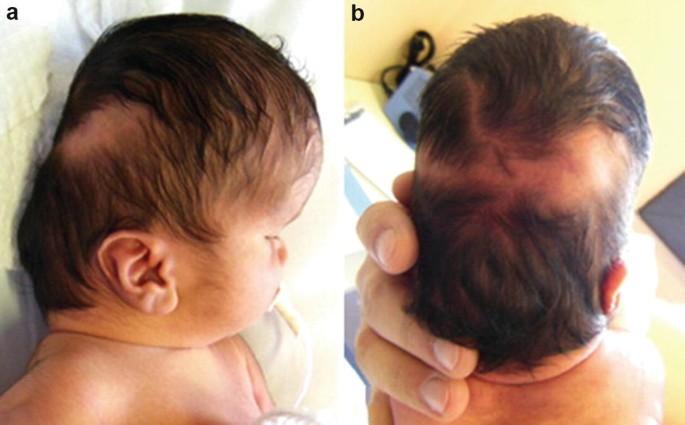 Gomez-Lopez-Hernandez Syndrome (GLHS) | SpringerLink