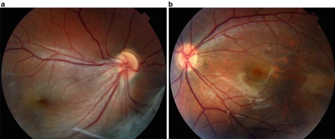 Autosomal Dominant Familial Exudative Vitreoretinopathy | Springer ...