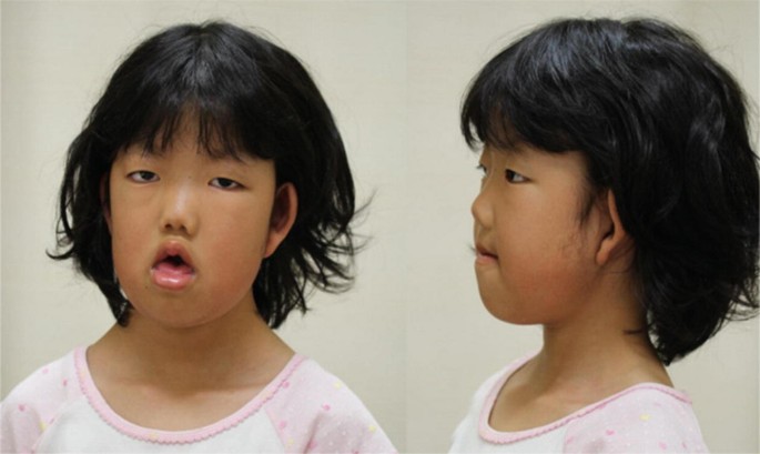 Au-Kline Syndrome (AUKS) | SpringerLink