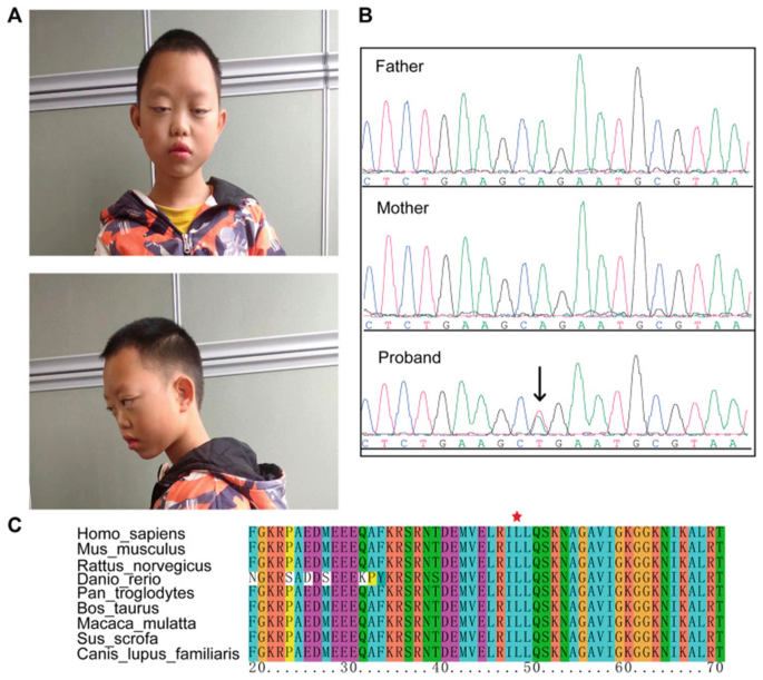 Au-Kline Syndrome (AUKS) | SpringerLink