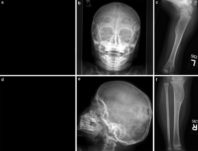 Potocki-Shaffer Syndrome | SpringerLink