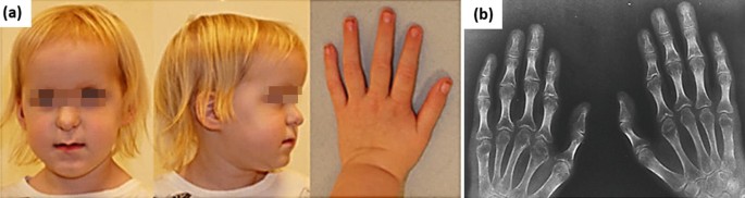 Trichorhinophalangeal Syndrome (TRPS): Types 1–3 | Springer Nature Link ...