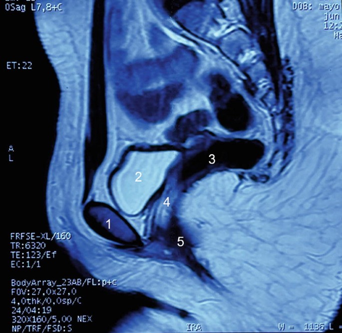 Mayer-Rokitansky-Küster-Hauser Syndrome (MRKH) | SpringerLink
