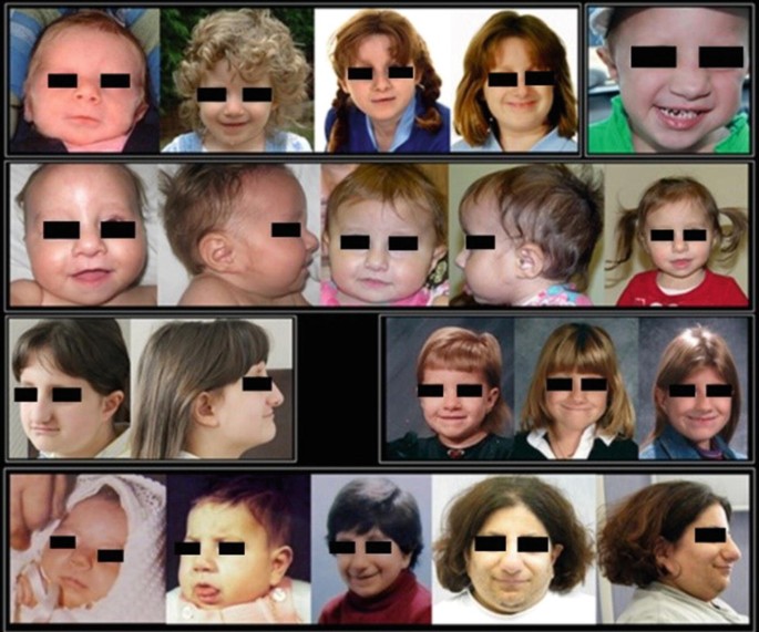 Floating-Harbor Syndrome (FLHS) | SpringerLink