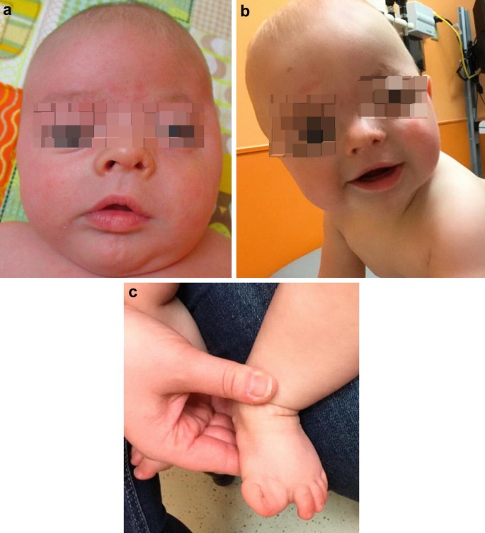 Curry-Jones Syndrome (CRJS) | SpringerLink