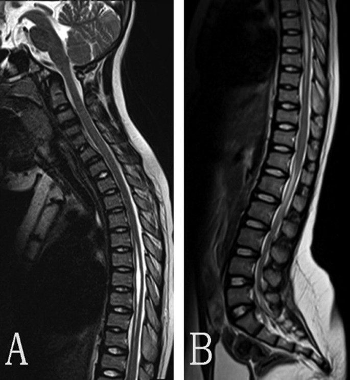 Imaging of Spinal CSF Disorders: Syringomyelia | SpringerLink