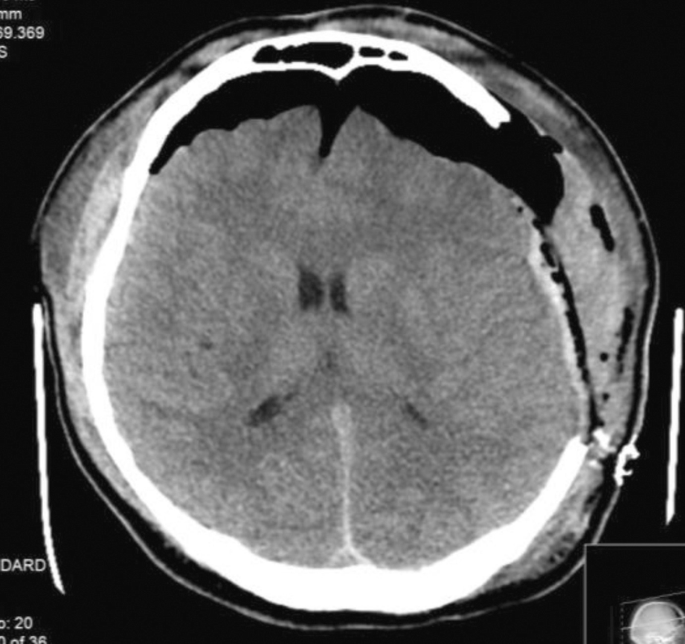 Acute Subdural Haematoma | SpringerLink