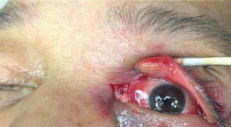 Trauma, Canalicular | SpringerLink