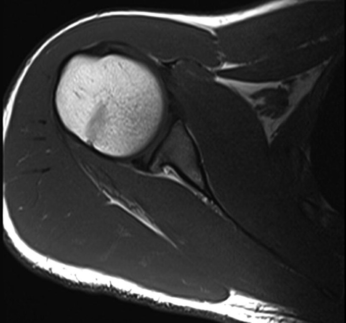 Multidirectional and Minor Shoulder Instabilities | SpringerLink
