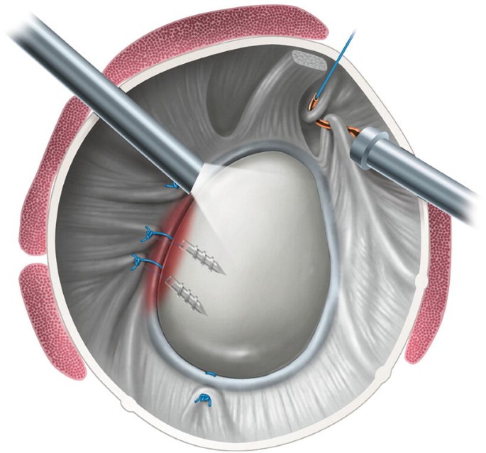 Multidirectional and Minor Shoulder Instabilities | SpringerLink