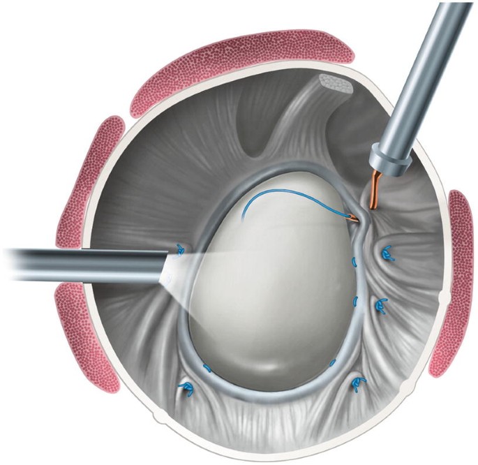 Multidirectional and Minor Shoulder Instabilities | SpringerLink