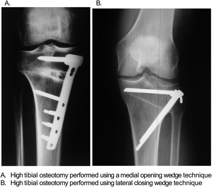 Return to Sport After High Tibial Osteotomy | SpringerLink