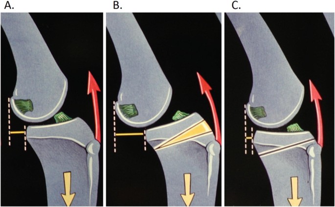 Return to Sport After High Tibial Osteotomy | SpringerLink