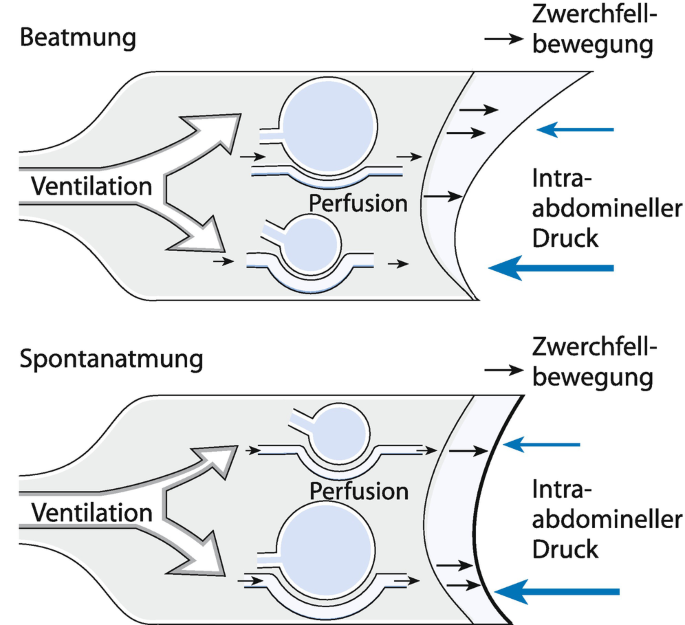 Lungenphysiologie und Beatmung in Allgemeinanästhesie | Springer Nature ...