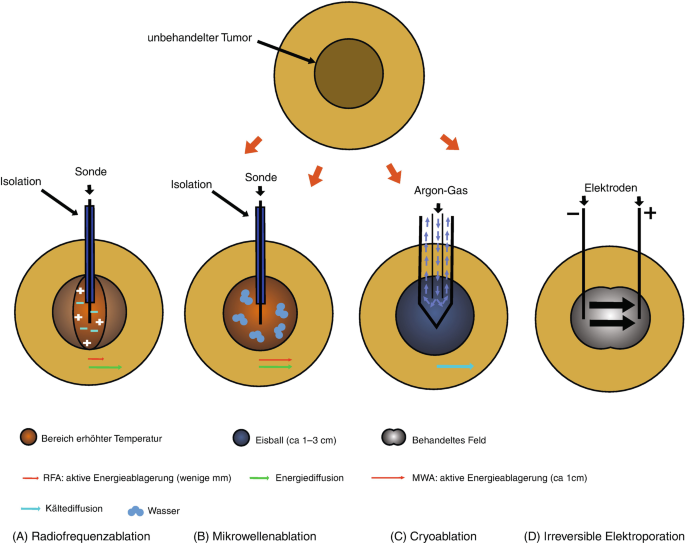 Prinzipien der nicht-chirurgischen lokoregionären Therapie | SpringerLink