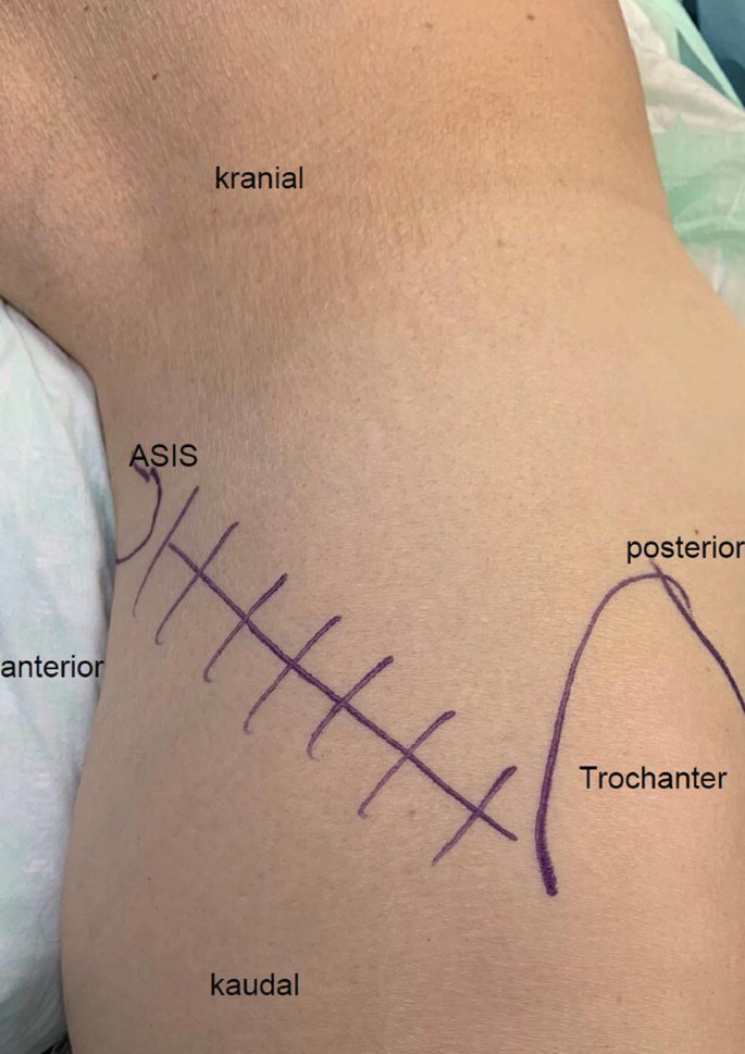 Zugänge zum Hüftgelenk: Anterolateraler Zugang zum Hüftgelenk | SpringerLink