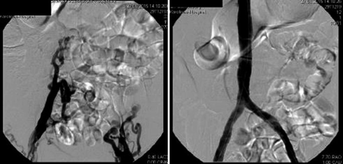 Beckenvenenthrombose | SpringerLink