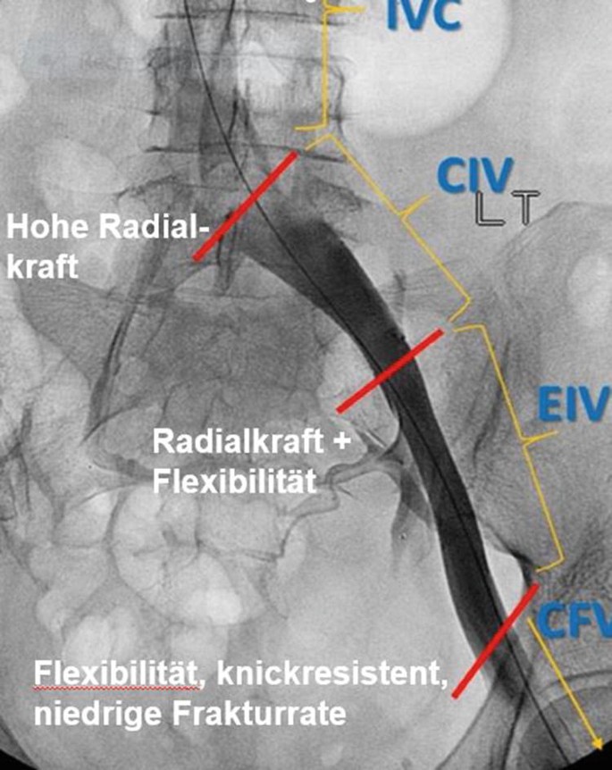 Invasive Therapie chronischer Beckenvenenobstruktionen | SpringerLink