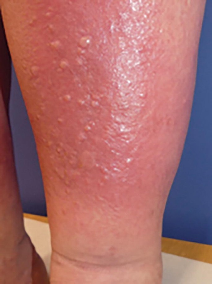 Klinisches Bild und diagnostisches Vorgehen bei Erkrankungen des ...