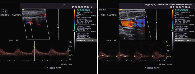 Stenosen und Verschlüsse der Arteria vertebralis | SpringerLink