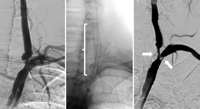 Stenosen und Verschlüsse der Arteria vertebralis | SpringerLink
