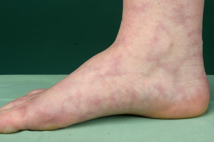 Livedovaskulopathie | SpringerLink