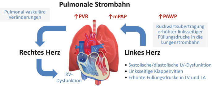 Pulmonale Hypertonie | SpringerLink