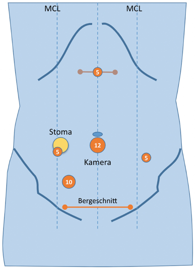 Colitis ulcerosa | SpringerLink