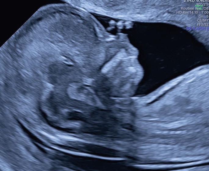 Ersttrimester-Klinik zum Zeitpunkt 11–13+6 Schwangerschaftswochen ...