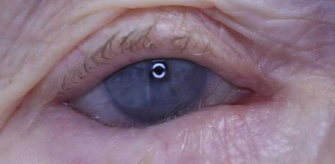 Entropium, Ektropium: Diagnose und Therapie | SpringerLink