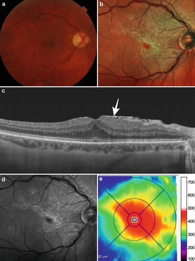 Traktive vitreomakuläre Erkrankungen | SpringerLink